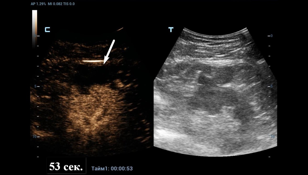 Ultrasound Journal 12 Multiparametric Ultrasound In Differentiating A
