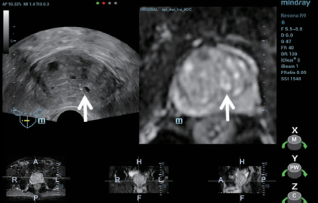 Ultrasound Journal 6 Improving Diagnostic Accuracy With Trus Mri
