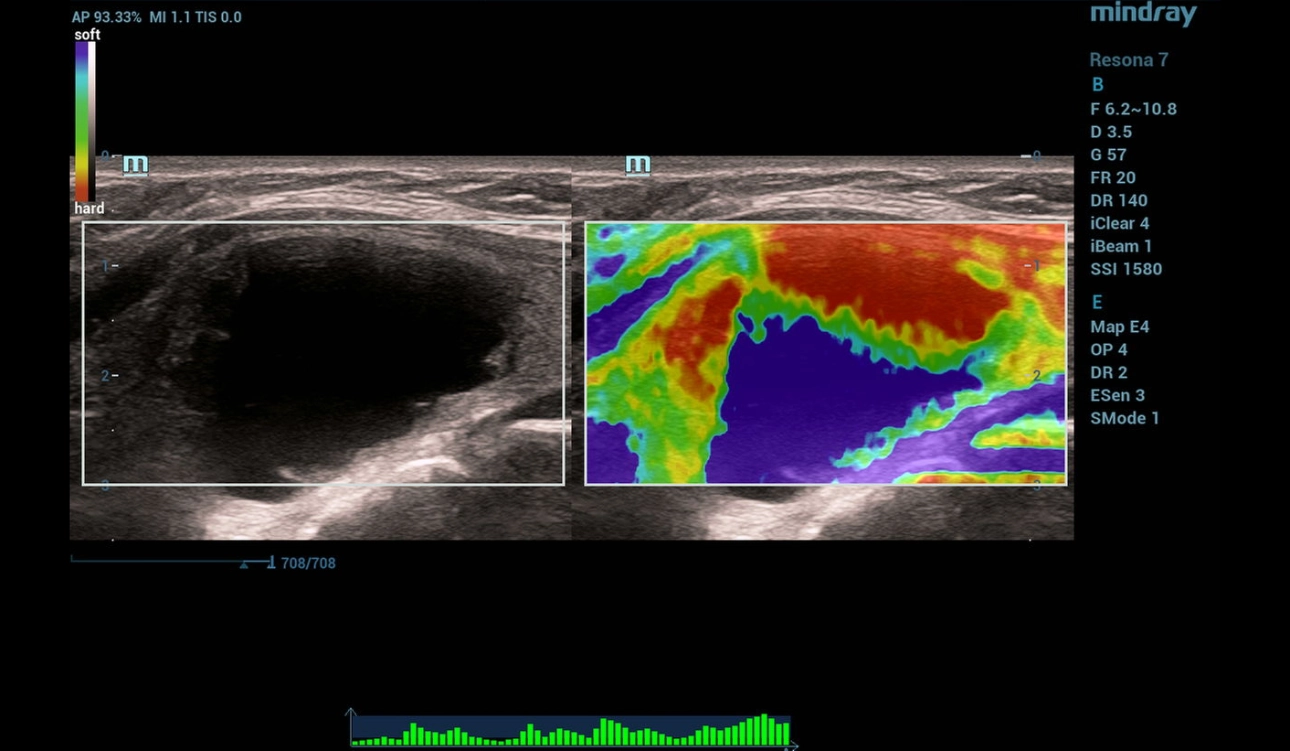 Ultrasound Journal 16 Application Of Ultrasound Guided Sclerotherapy