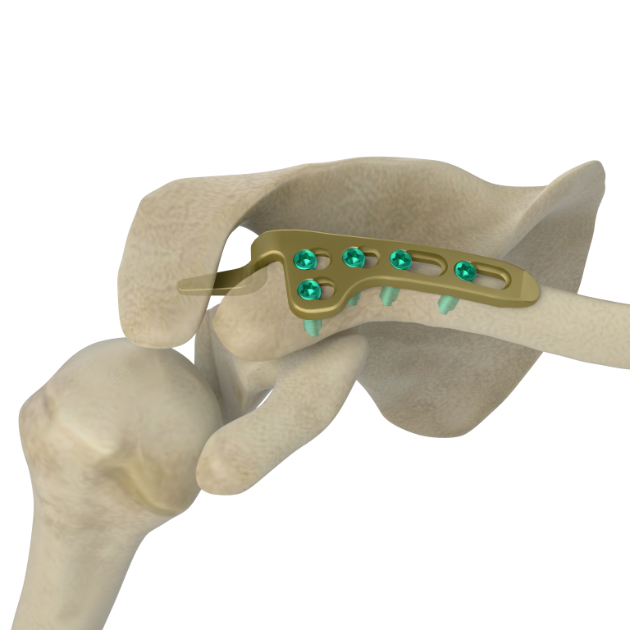 Trama Comprehensive Solution - Locking Plate - Mindray