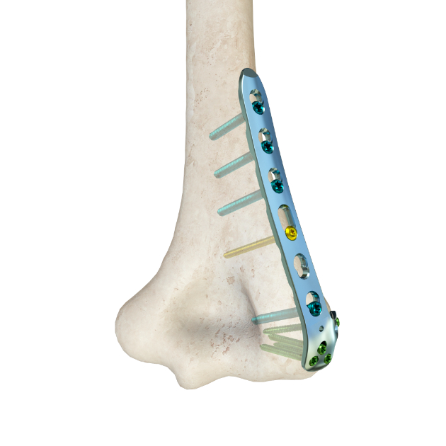 Trama Comprehensive Solution - Locking Plate - Mindray