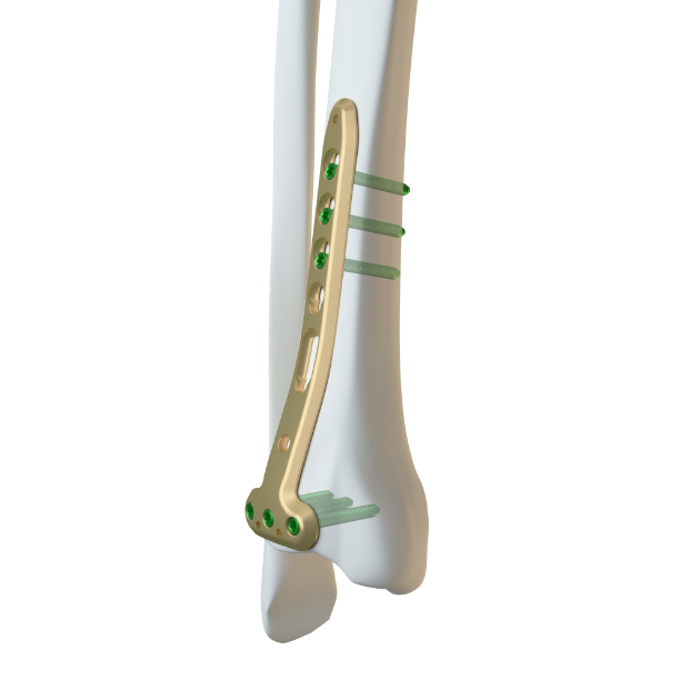 Trama Comprehensive Solution - Locking Plate - Mindray