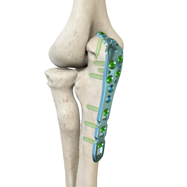 Trama Comprehensive Solution - Locking Plate - Mindray