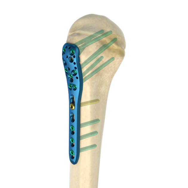 Trama Comprehensive Solution - Locking Plate - Mindray