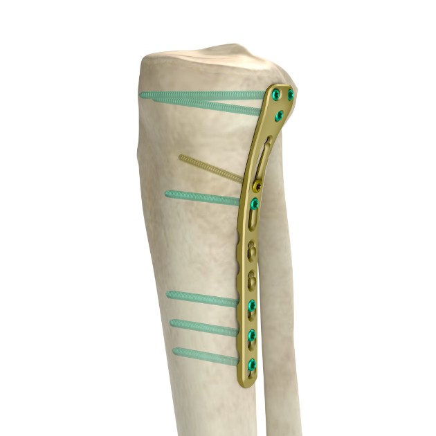 Trama Comprehensive Solution - Locking Plate - Mindray