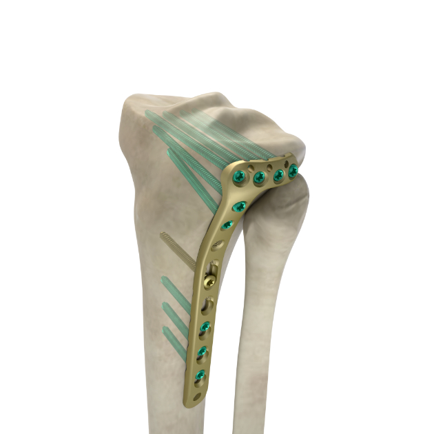 Trama Comprehensive Solution - Locking Plate - Mindray