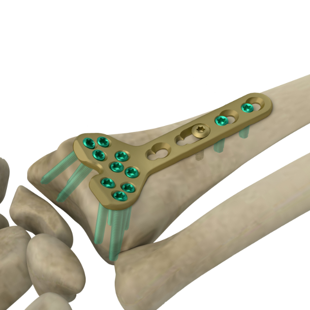 Trama Comprehensive Solution - Locking Plate - Mindray