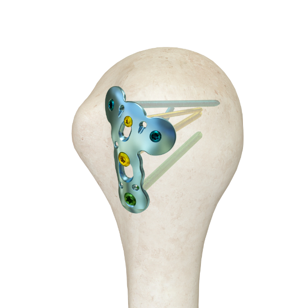 Trama Comprehensive Solution - Locking Plate - Mindray