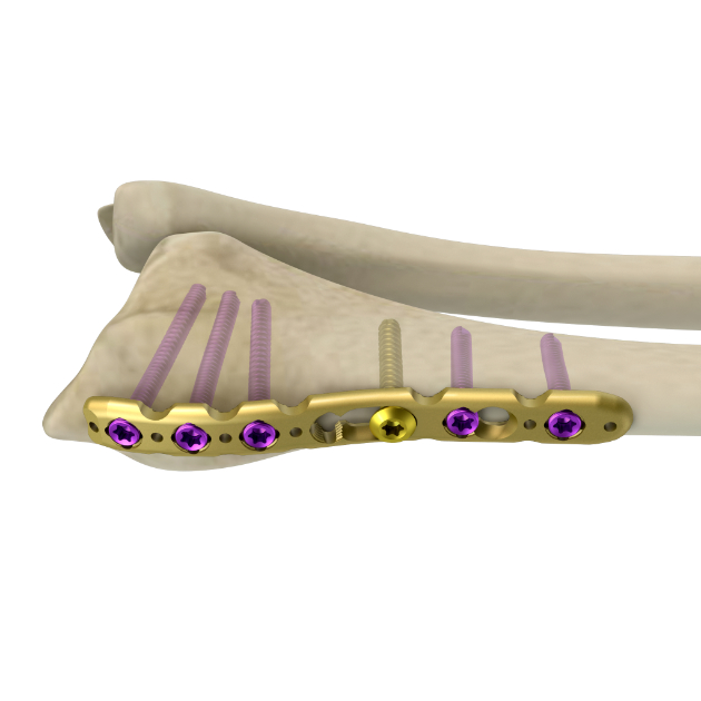 Trama Comprehensive Solution - Locking Plate - Mindray