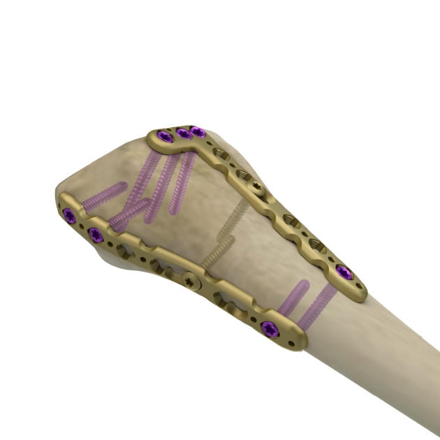 Trama Comprehensive Solution - Locking Plate - Mindray