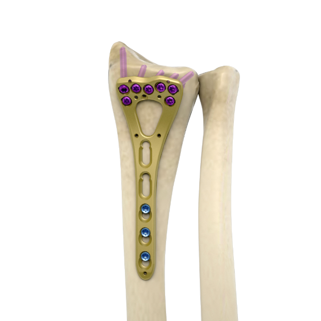Trama Comprehensive Solution - Locking Plate - Mindray