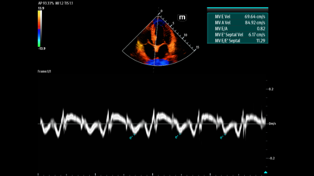Point of Care Ultrasound System - TEX20 Elite Edition - Mindray Global ...