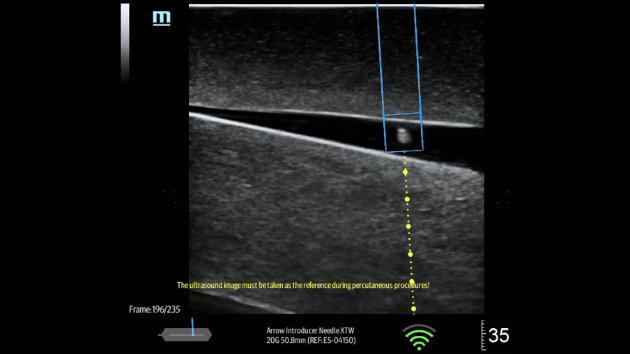 Point of Care Ultrasound System - TEX20 Elite Edition - Mindray Global ...