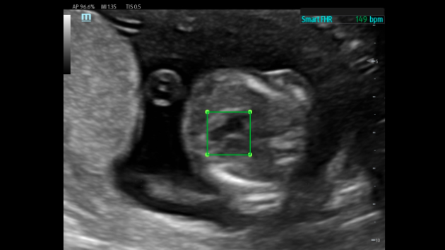 Point of Care Ultrasound System - TEX20 Elite Edition - Mindray Global ...