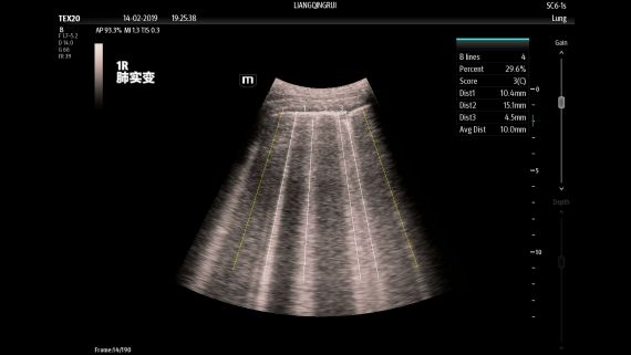 Point of Care Ultrasound System | TEX20 Series - Mindray