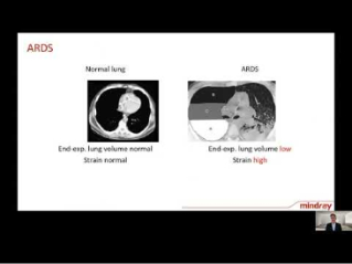 Lung Protective Ventilation Webinar - Mindray