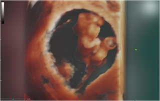 Ultrasound Journal 30 - Fetal Body Stalk Anomaly Diagnosis - Mindray