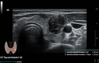Ultrasound Journal 32 - Multiparametric Ultrasound for the Characterization of Thyroid Nodule: A ...