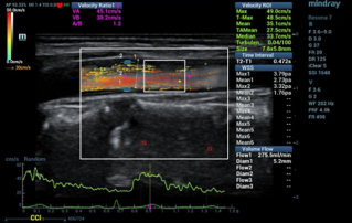 Ultrasound Journal 22 - V Flow Doppler Patterns of Carotid ...